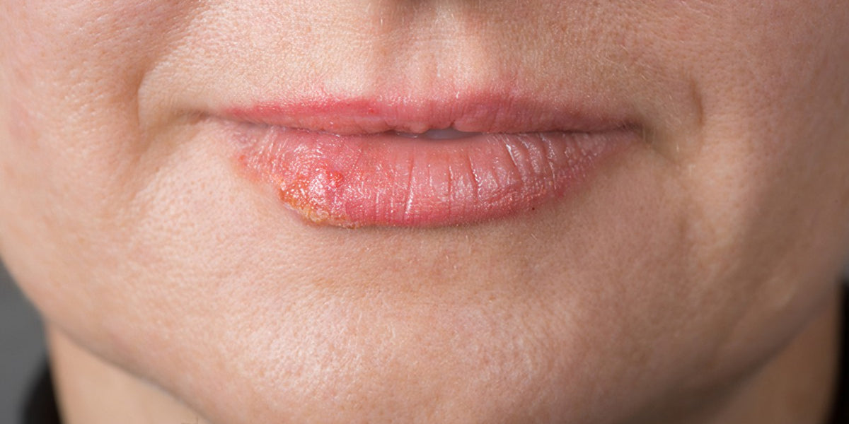 Kiss Winter Cold Sores (Fever Blisters) Goodbye! — Feelgood Health